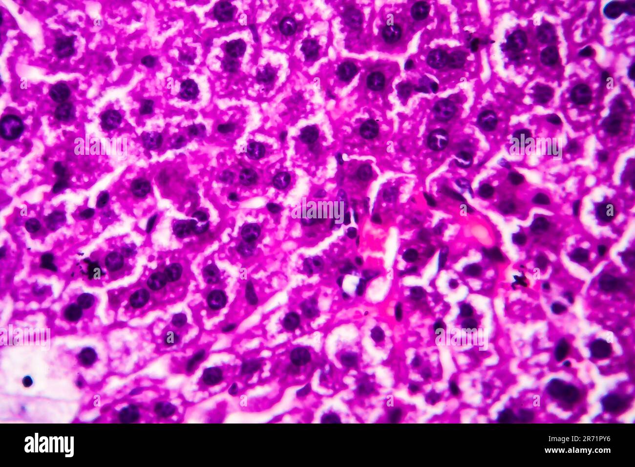 Histopathology of acute hepatitis, light micrograph, photo under ...
