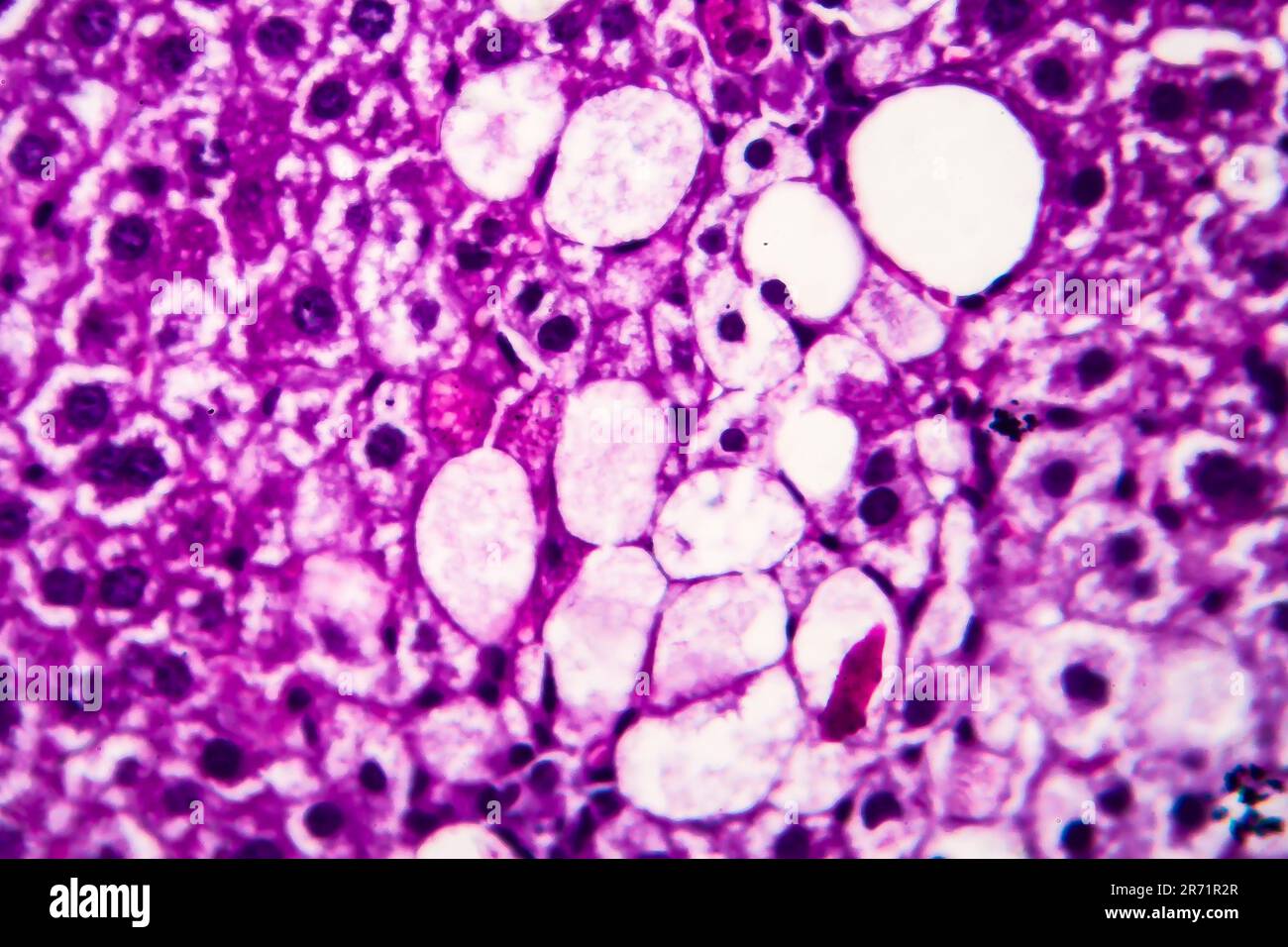 Histopathology of acute hepatitis, light micrograph, photo under ...