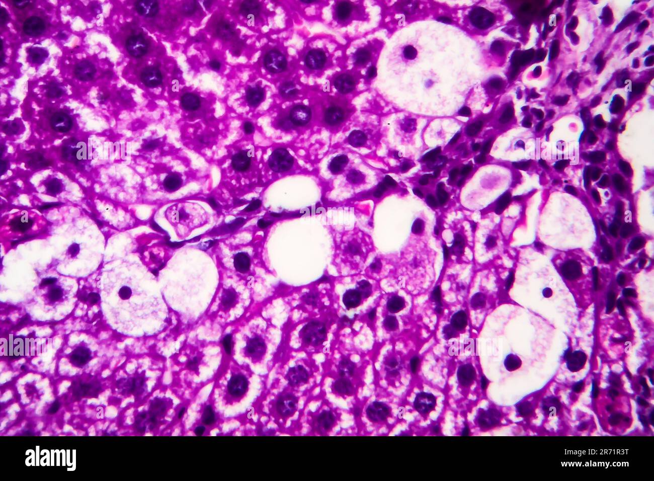 Histopathology of acute hepatitis, light micrograph, photo under ...