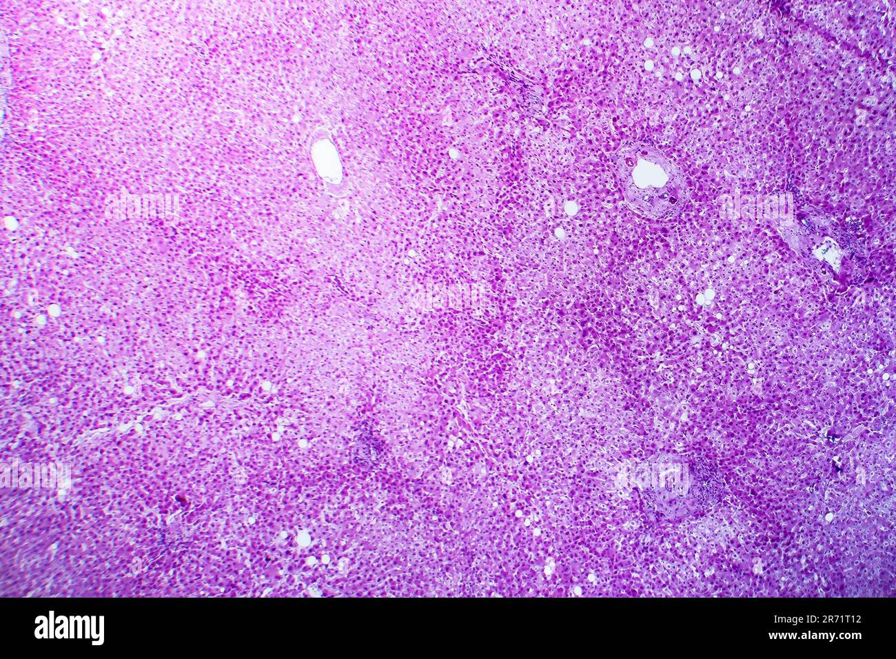 Cloudy swelling of the liver, light micrograph, photo under microscope ...