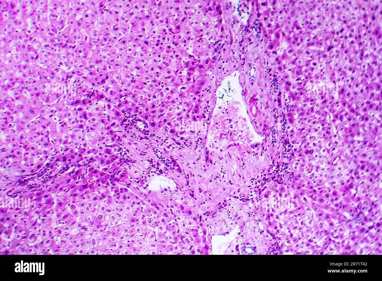 Cloudy swelling of the liver, light micrograph, photo under microscope ...