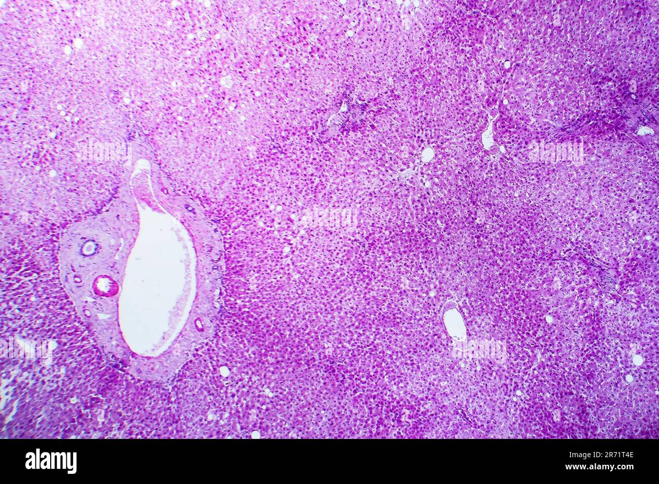 Cloudy swelling of the liver, light micrograph, photo under microscope ...