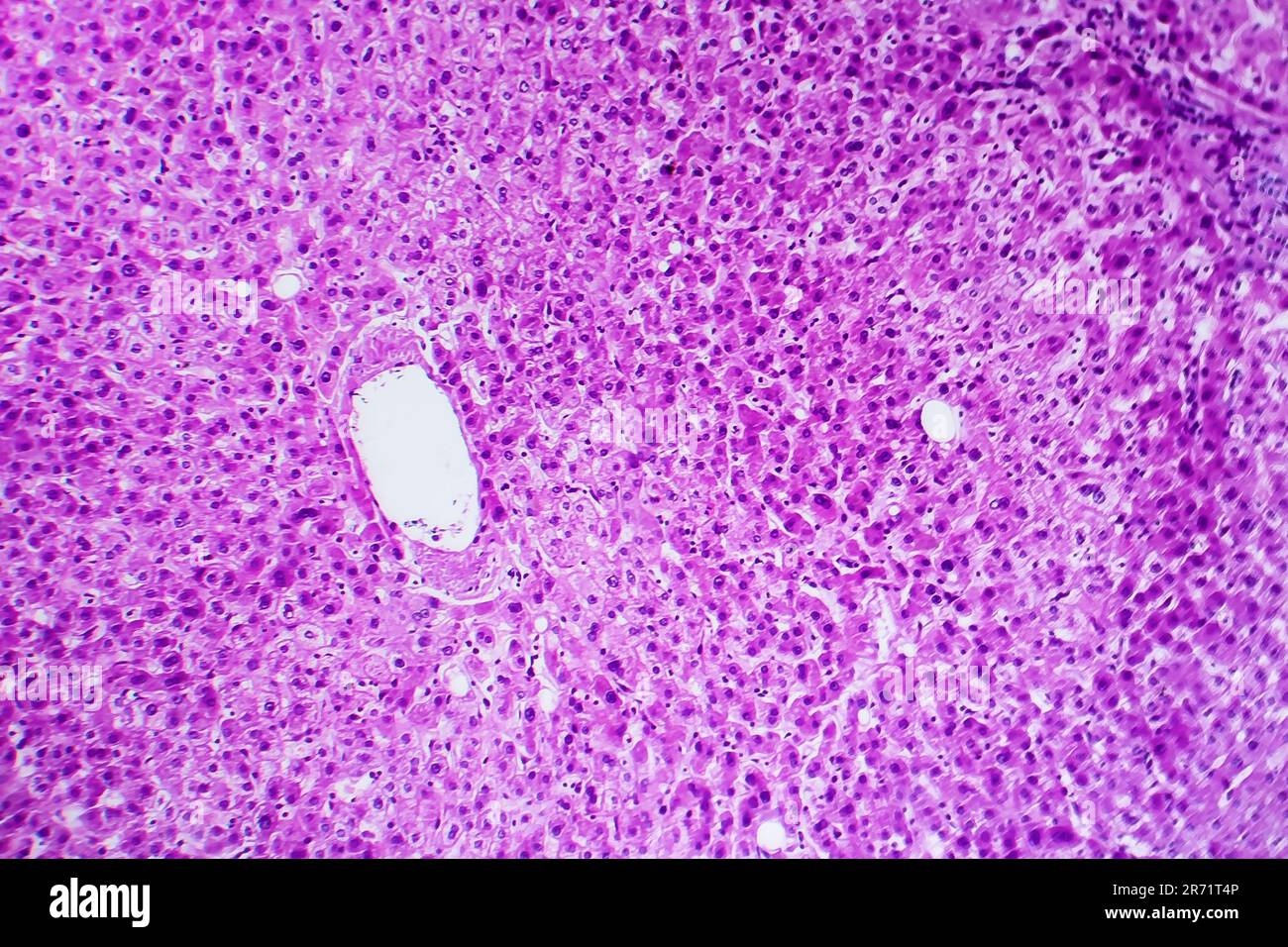 Cloudy swelling of the liver, light micrograph, photo under microscope ...