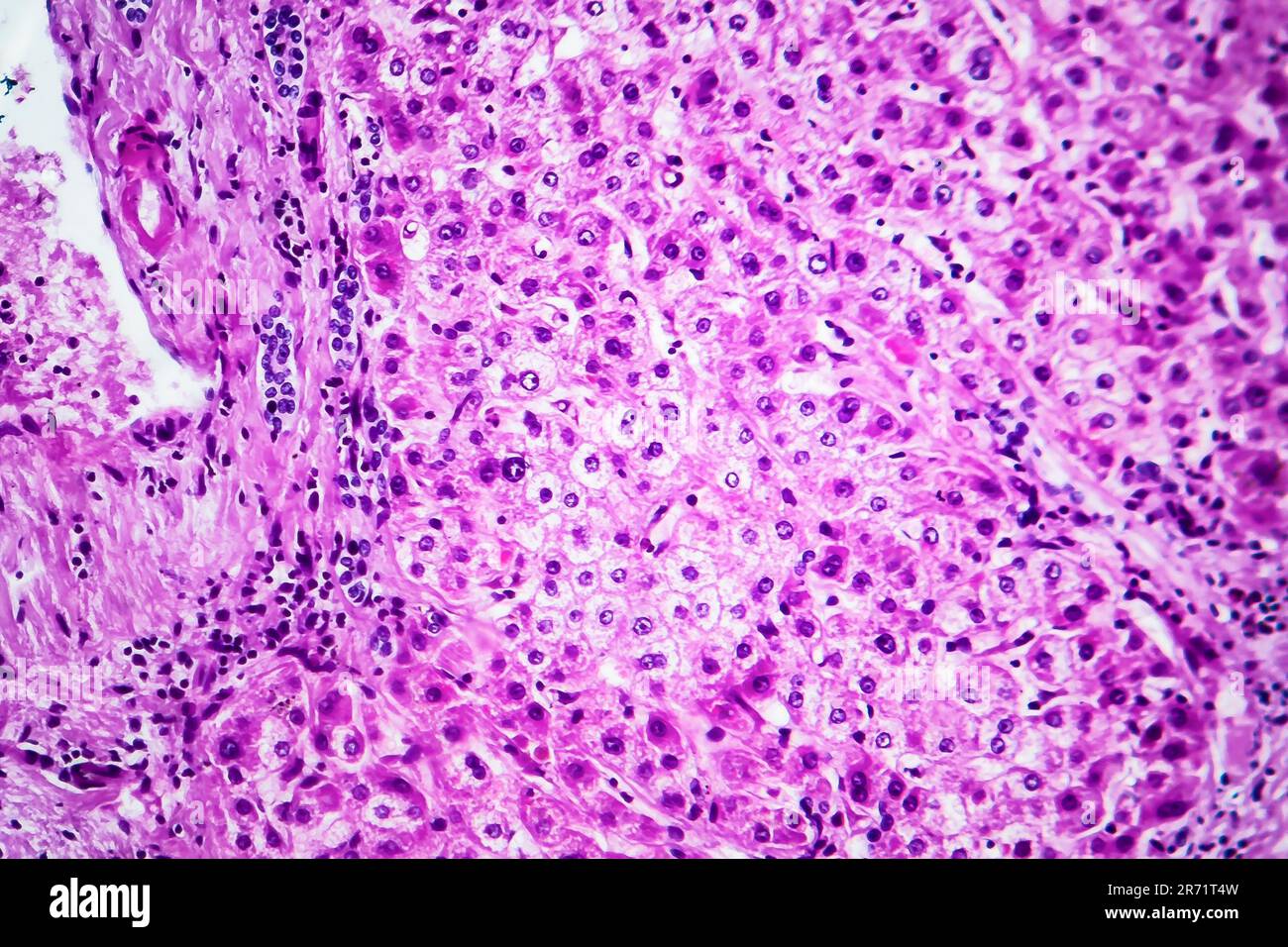 Cloudy swelling of the liver, light micrograph, photo under microscope ...