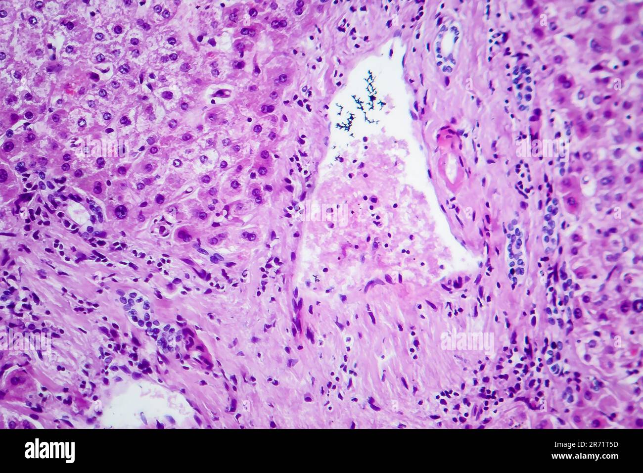 Cloudy swelling of the liver, light micrograph, photo under microscope ...