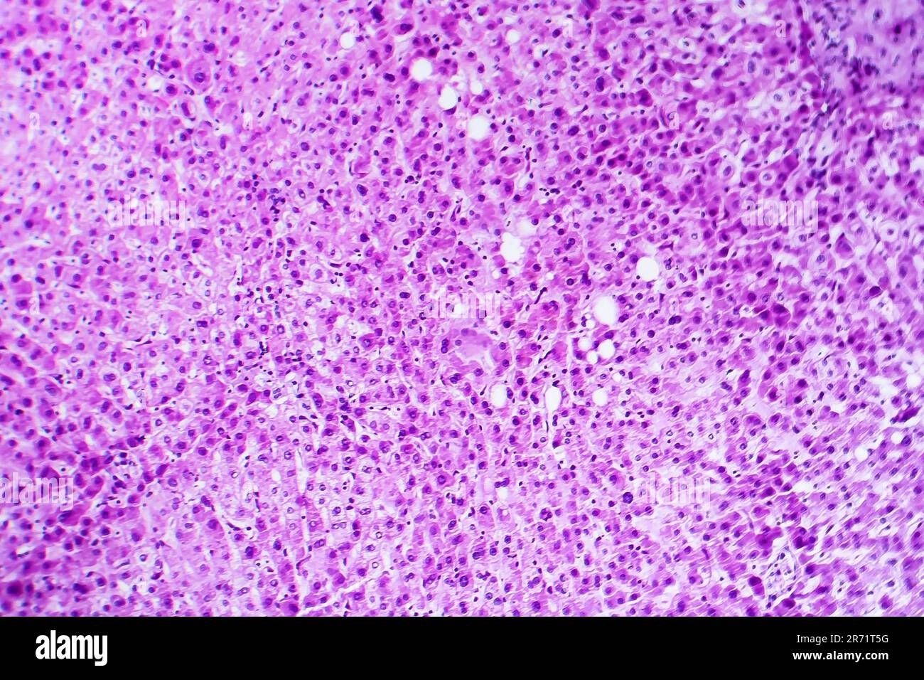 Cloudy swelling of the liver, light micrograph, photo under microscope ...