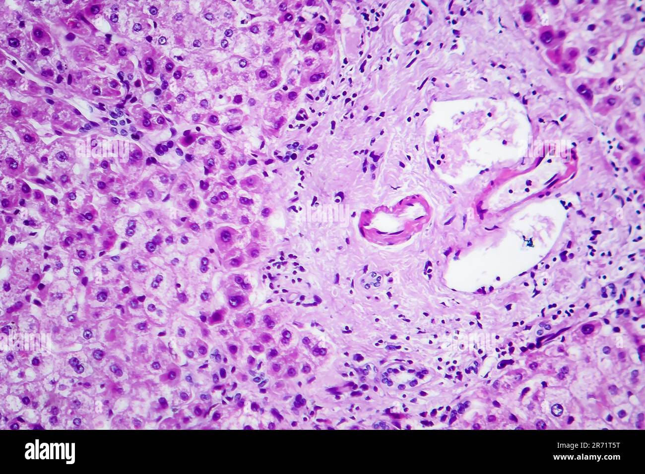 Cloudy swelling of the liver, light micrograph, photo under microscope ...