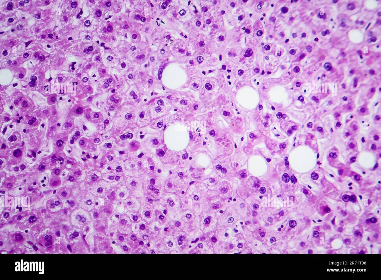 Cloudy swelling of the liver, light micrograph, photo under microscope ...