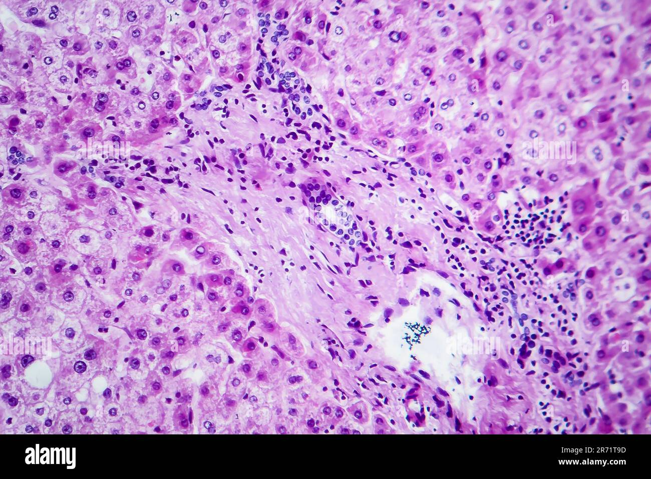 Cloudy swelling of the liver, light micrograph, photo under microscope ...