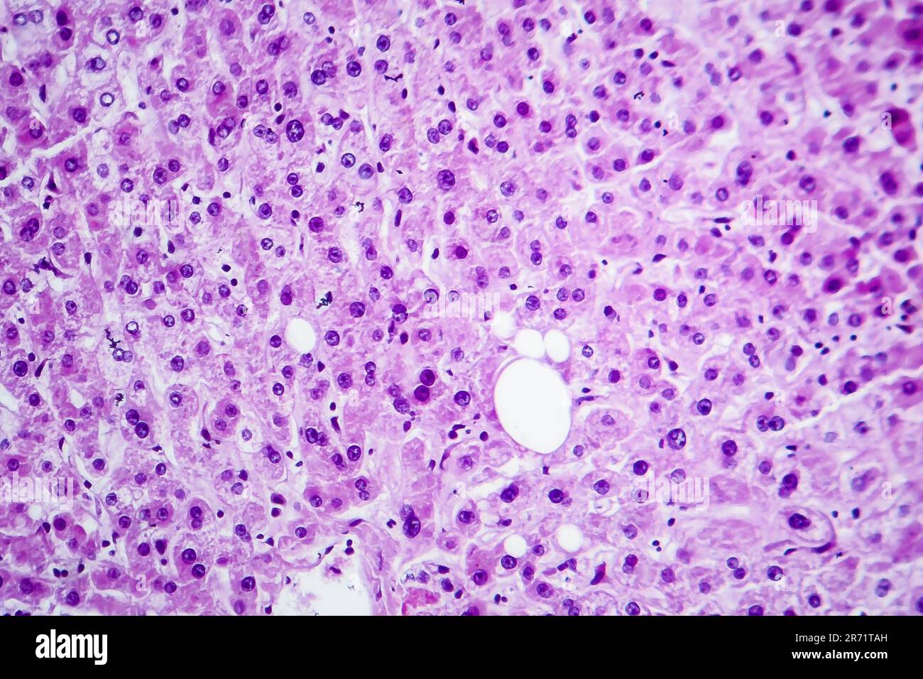 Cloudy swelling of the liver, light micrograph, photo under microscope ...