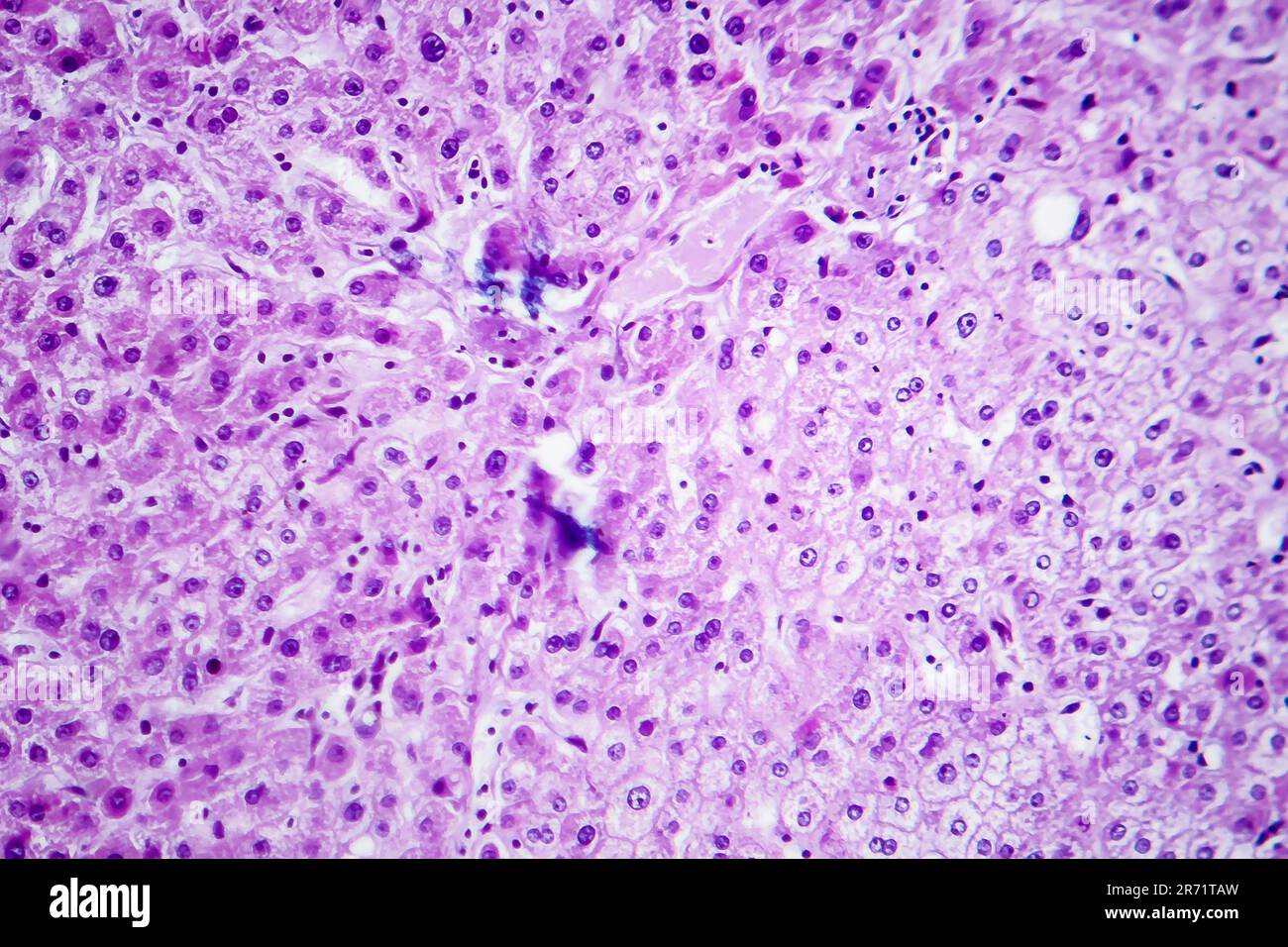 Cloudy swelling of the liver, light micrograph, photo under microscope ...