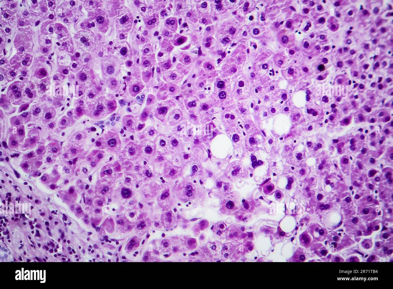 Cloudy swelling of the liver, light micrograph, photo under microscope ...