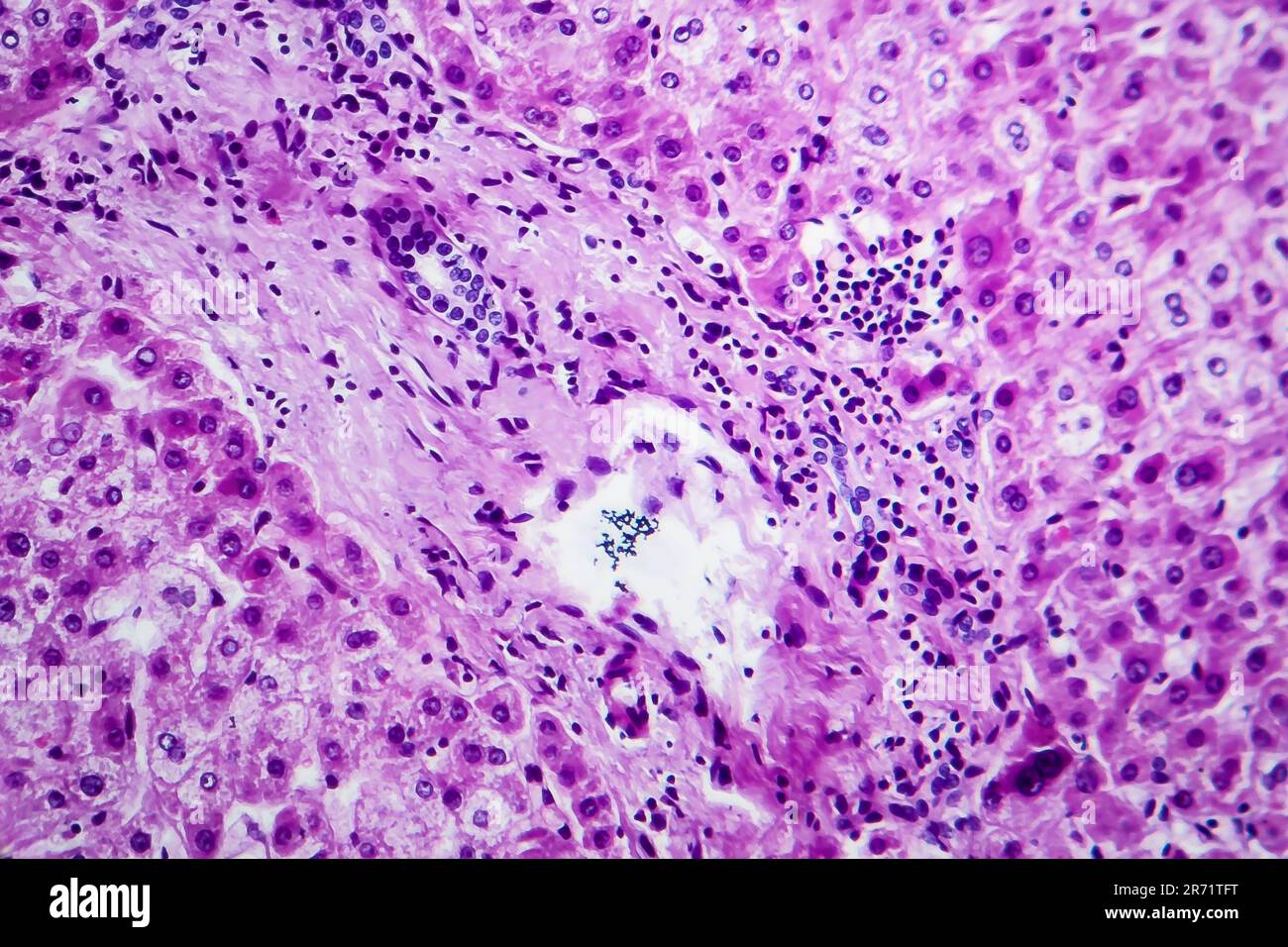 Cloudy swelling of the liver, light micrograph, photo under microscope ...