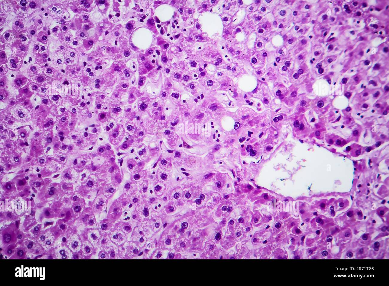 Cloudy swelling of the liver, light micrograph, photo under microscope ...