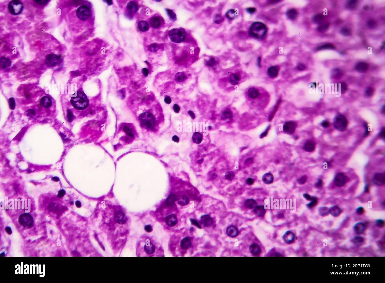 Cloudy swelling of the liver, light micrograph, photo under microscope ...