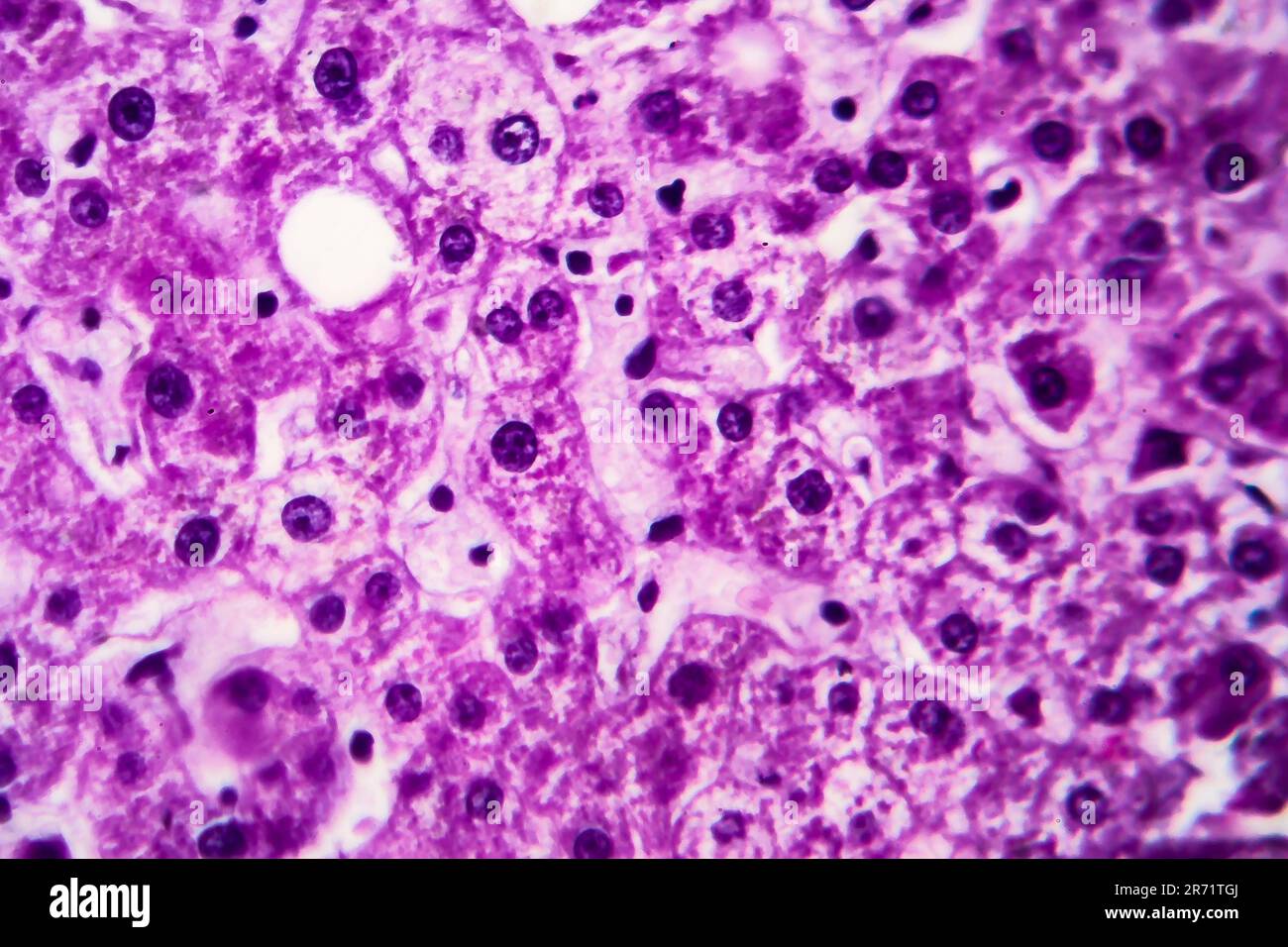Cloudy swelling of the liver, light micrograph, photo under microscope ...