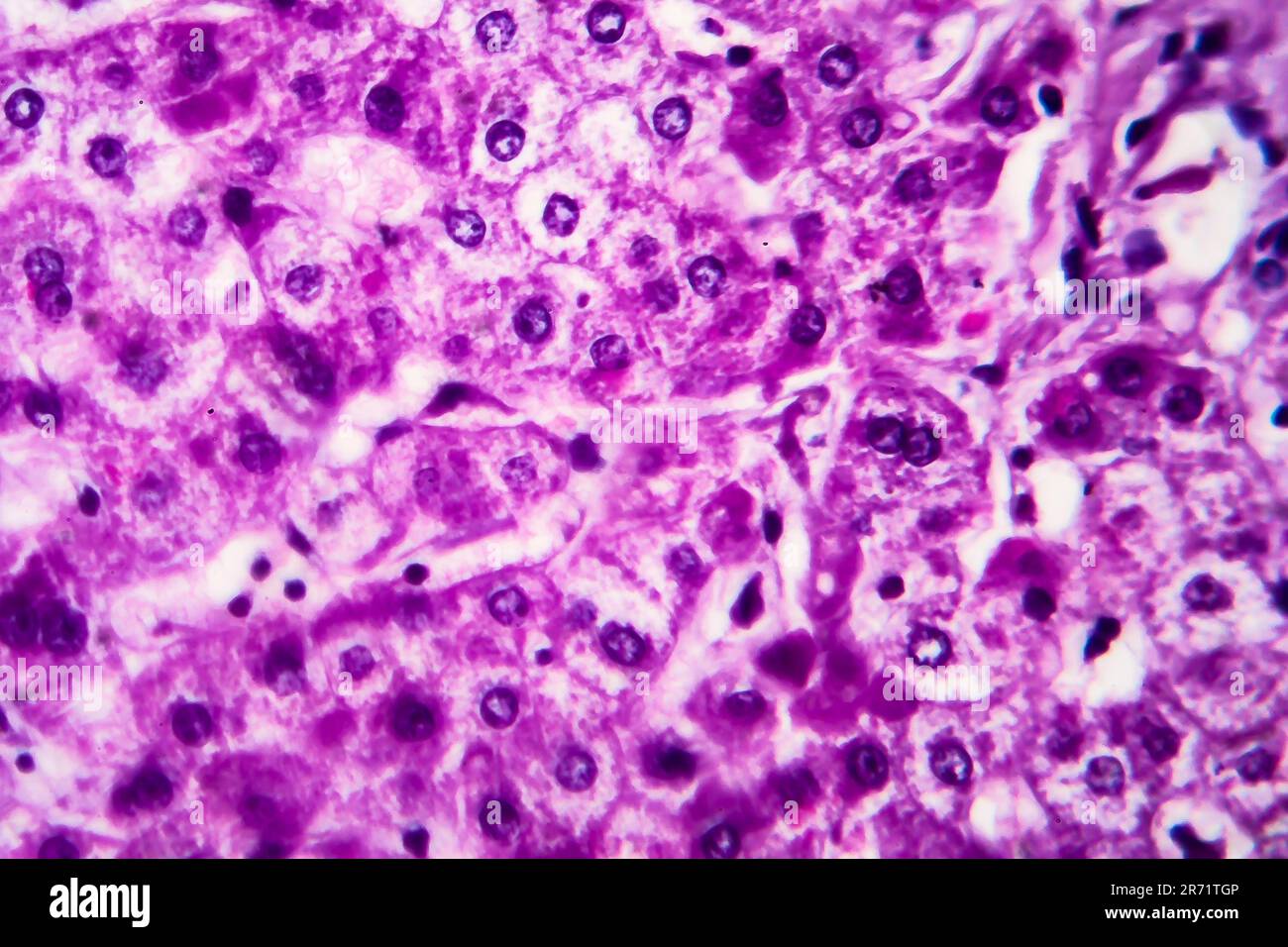 Cloudy swelling of the liver, light micrograph, photo under microscope ...