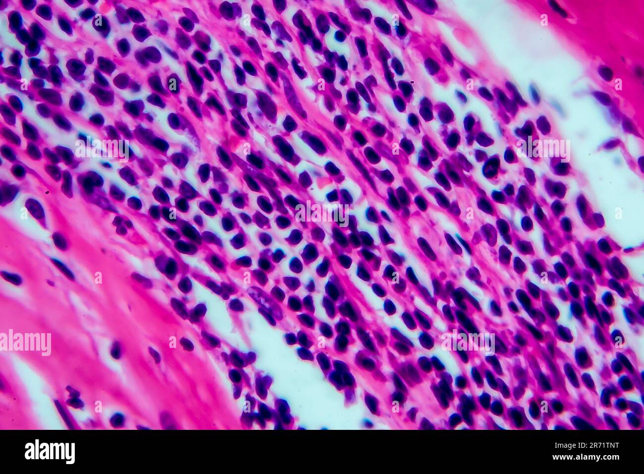 Hodgkin's lymphoma, light micrograph, photo under microscope. High ...