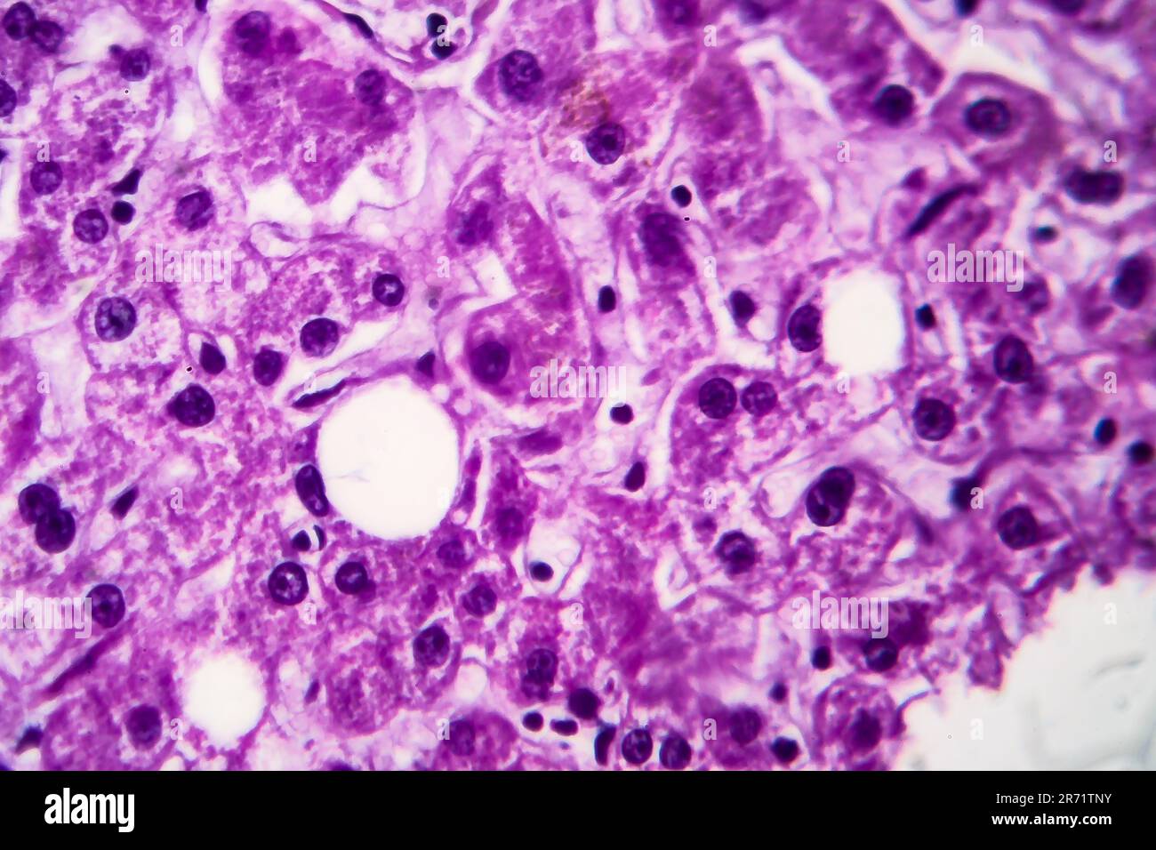 Cloudy swelling of the liver, light micrograph, photo under microscope ...