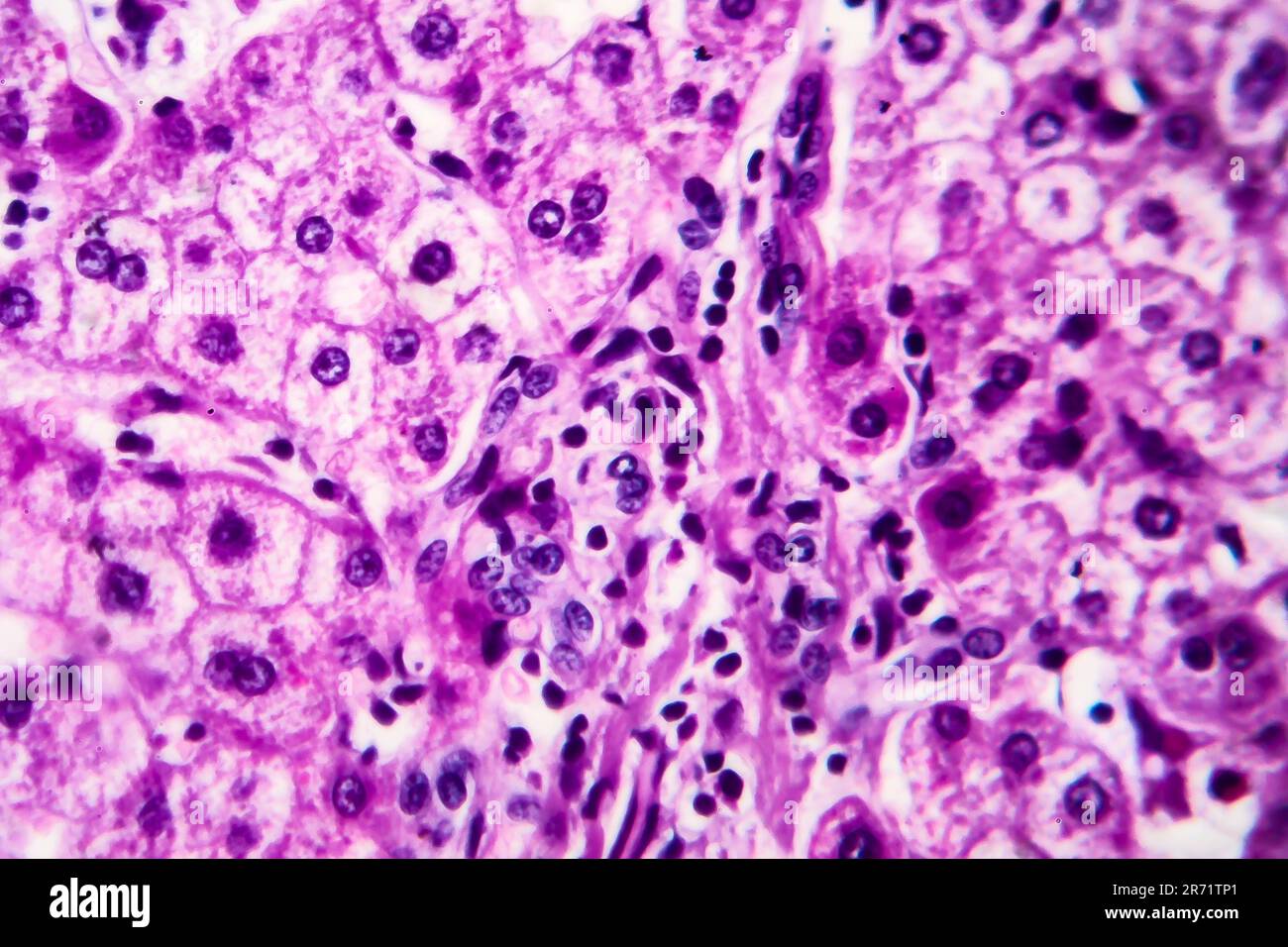 Cloudy swelling of the liver, light micrograph, photo under microscope ...