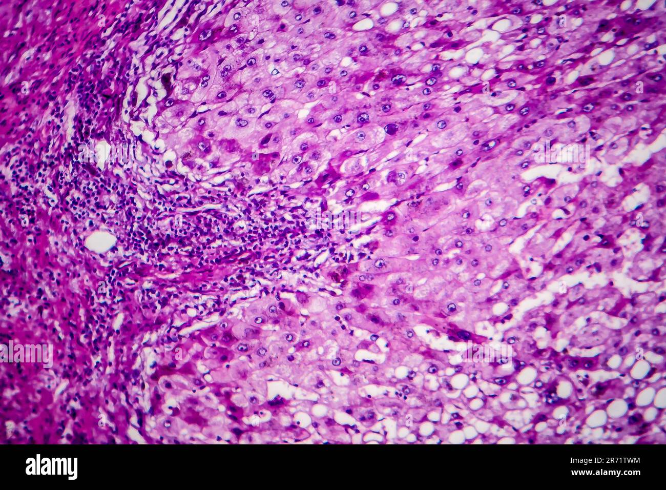 Histopathology of alcoholic hepatitis, light micrograph, photo under ...