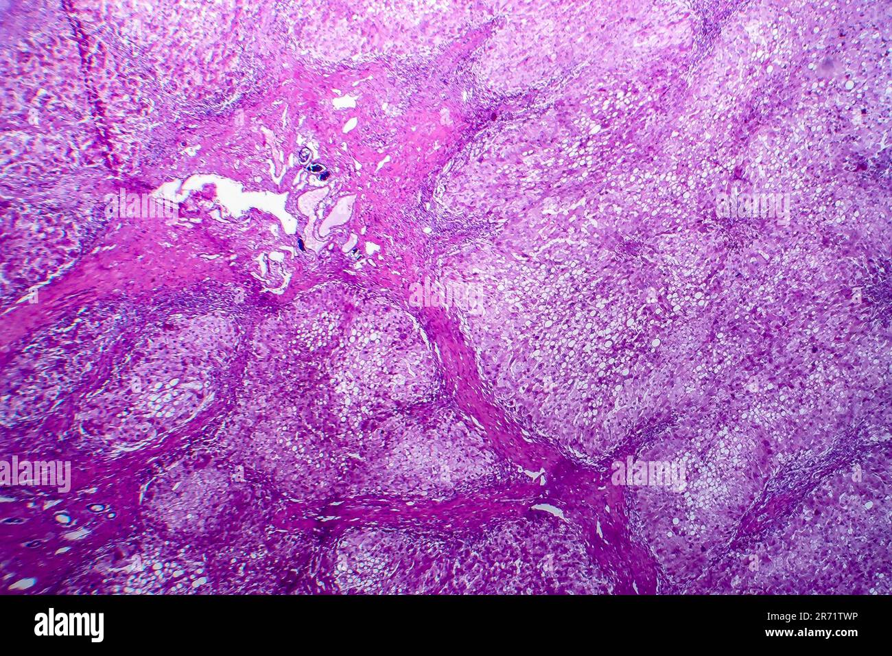 Histopathology of alcoholic hepatitis, light micrograph, photo under ...