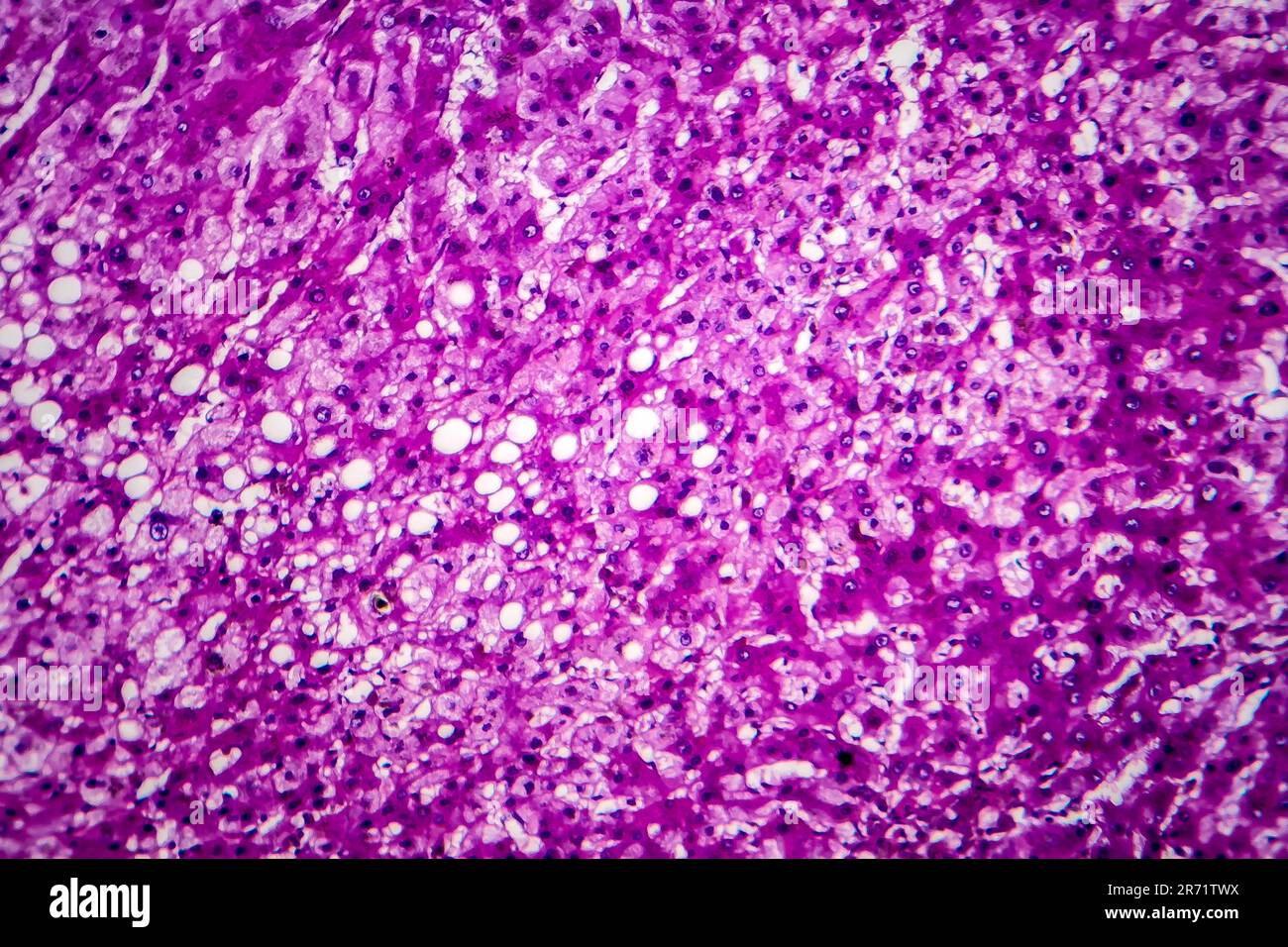 Histopathology of alcoholic hepatitis, light micrograph, photo under ...