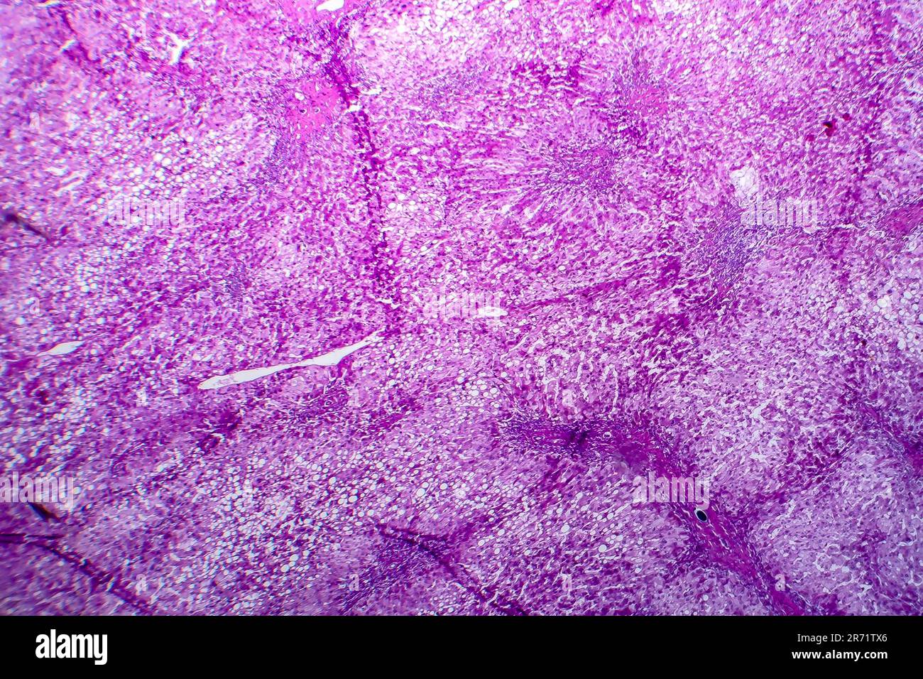 Histopathology of alcoholic hepatitis, light micrograph, photo under ...