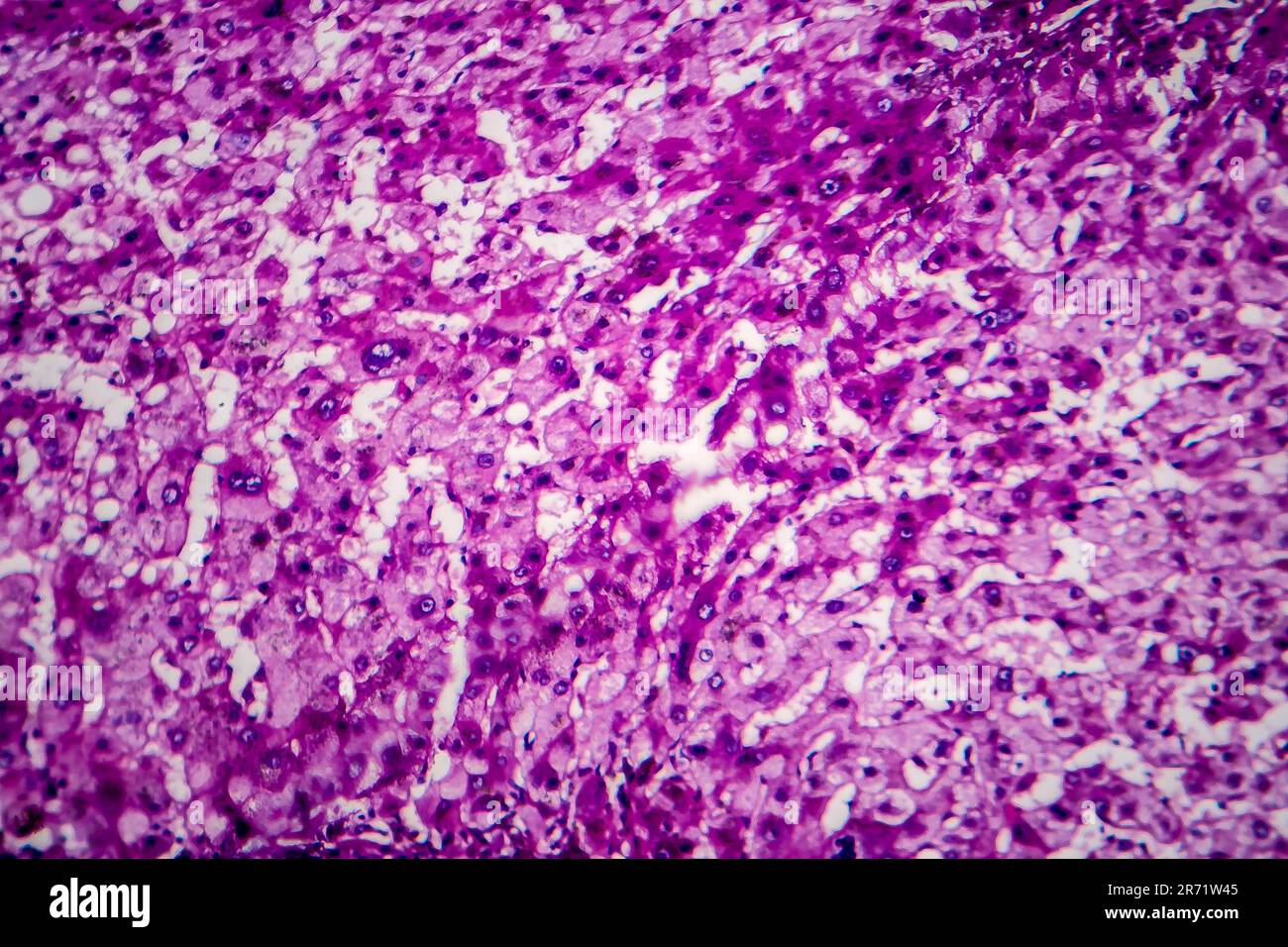 Histopathology of alcoholic hepatitis, light micrograph, photo under ...