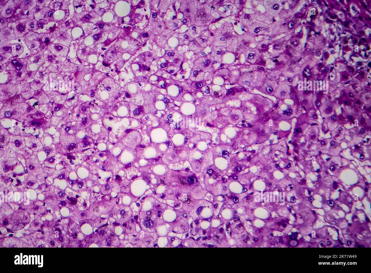 Histopathology of alcoholic hepatitis, light micrograph, photo under ...