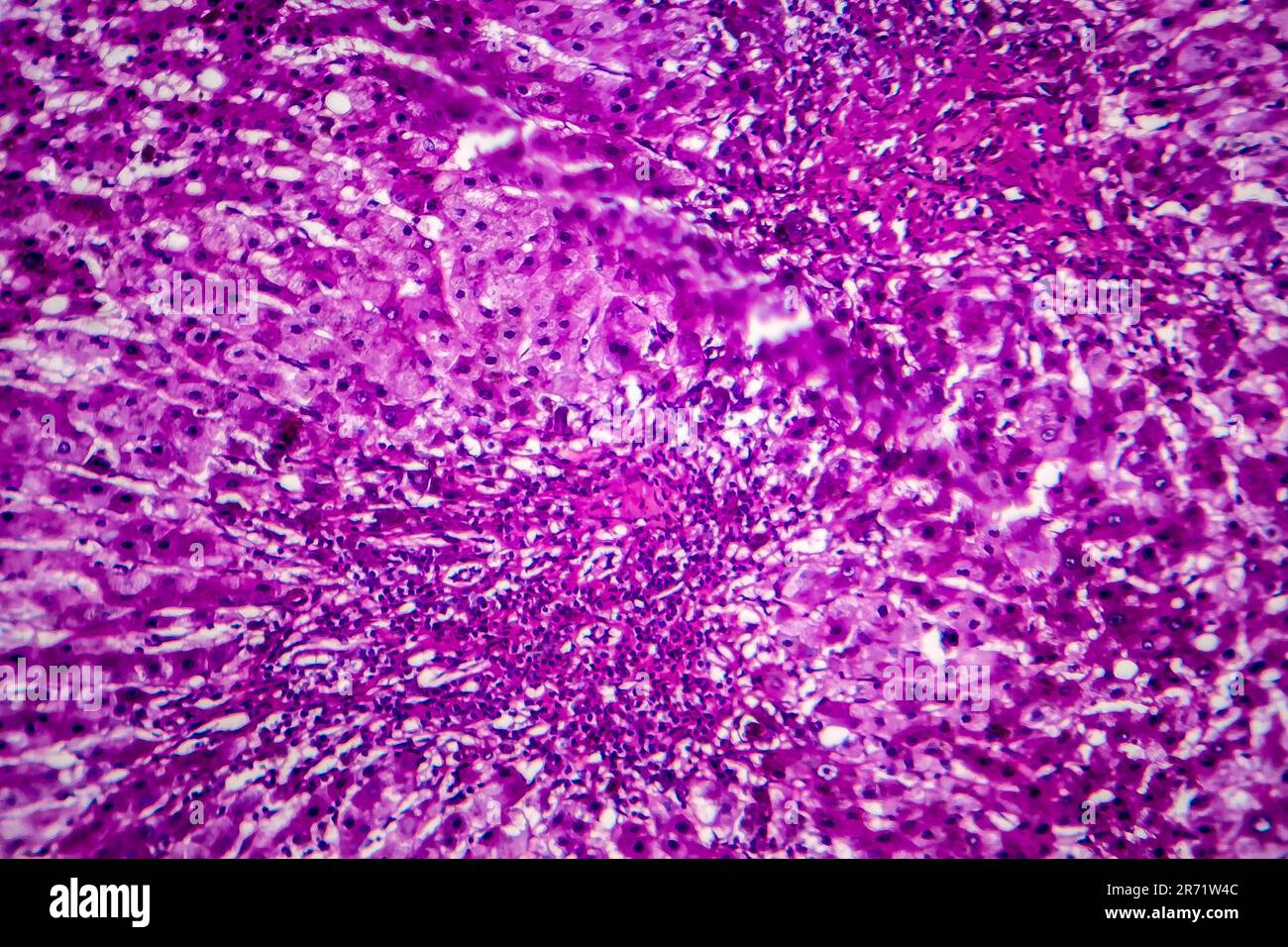 Histopathology of alcoholic hepatitis, light micrograph, photo under ...