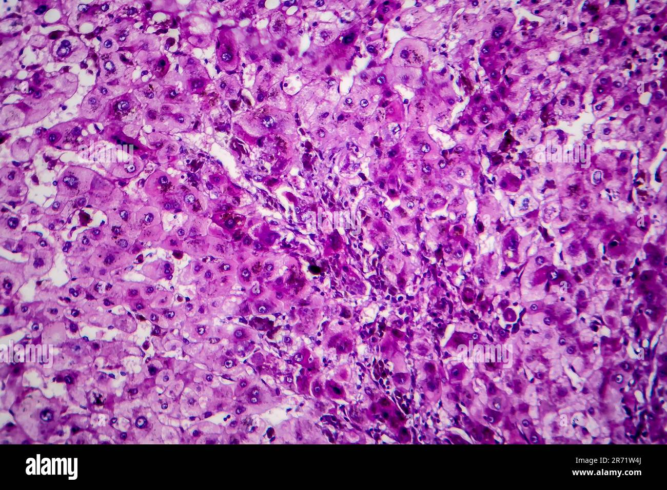 Histopathology of alcoholic hepatitis, light micrograph, photo under ...