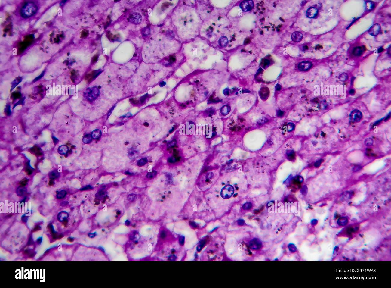 Histopathology of alcoholic hepatitis, light micrograph, photo under ...
