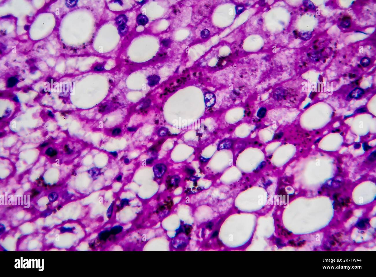 Histopathology of alcoholic hepatitis, light micrograph, photo under ...