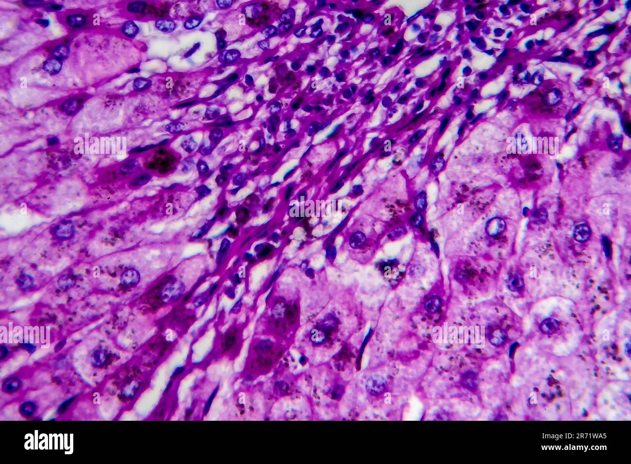 Histopathology of alcoholic hepatitis, light micrograph, photo under ...