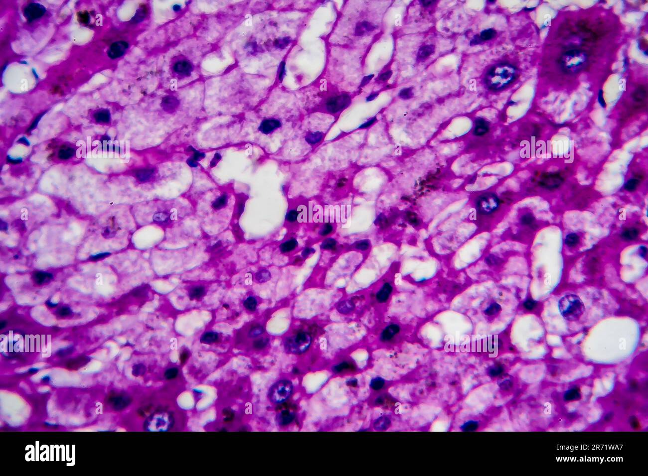 Histopathology of alcoholic hepatitis, light micrograph, photo under ...
