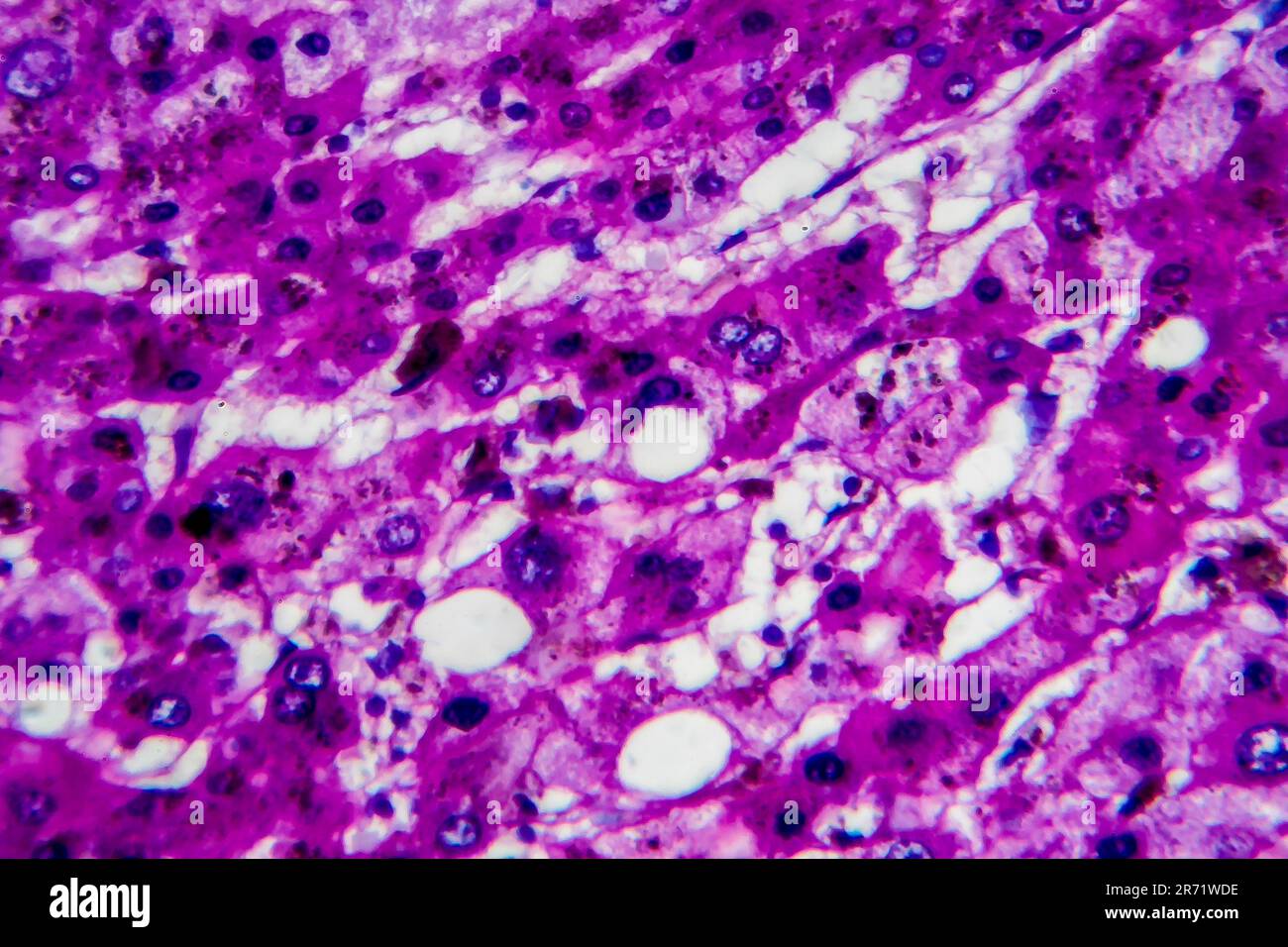 Histopathology of alcoholic hepatitis, light micrograph, photo under ...