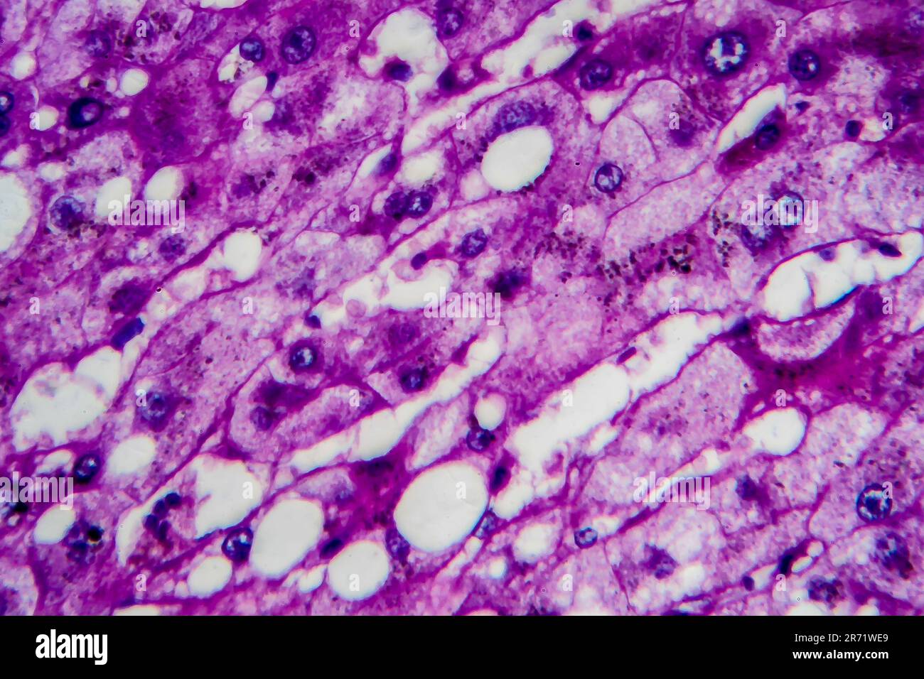 Histopathology of alcoholic hepatitis, light micrograph, photo under ...