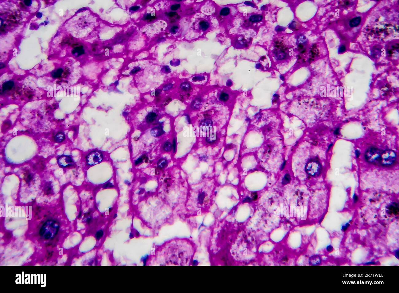 Histopathology of alcoholic hepatitis, light micrograph, photo under ...