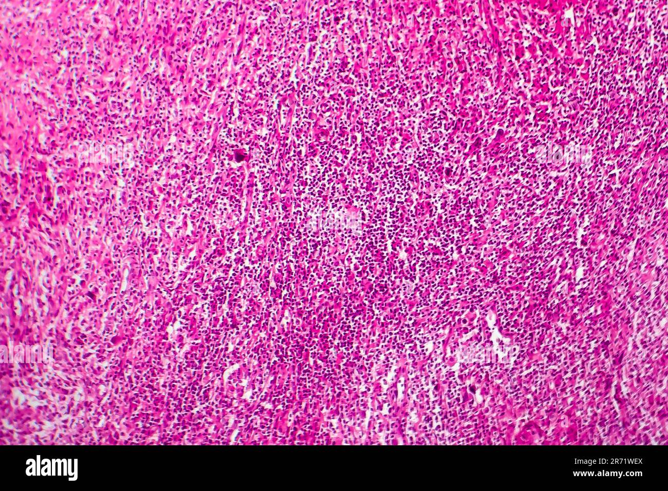 Non-Hodgkin's lymphoma, light micrograph, photo under microscope Stock ...