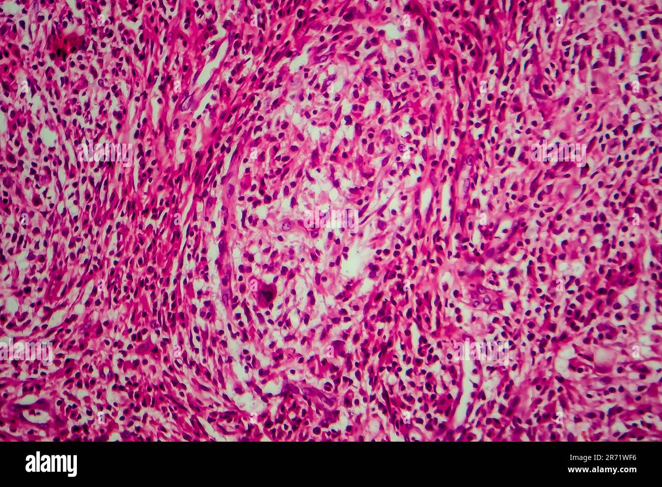 Non-Hodgkin's lymphoma, light micrograph, photo under microscope Stock ...