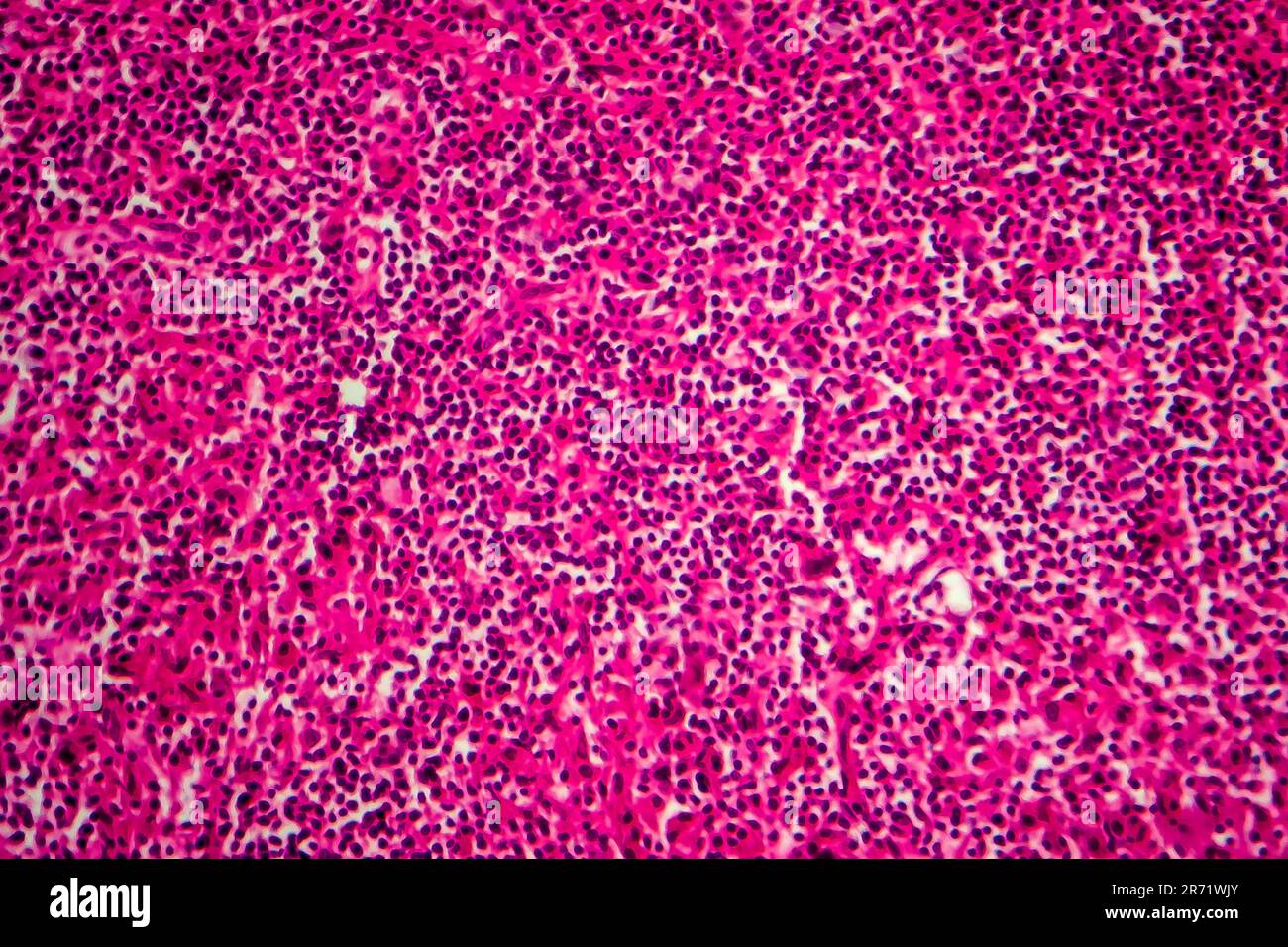 Non-Hodgkin's lymphoma, light micrograph, photo under microscope Stock ...