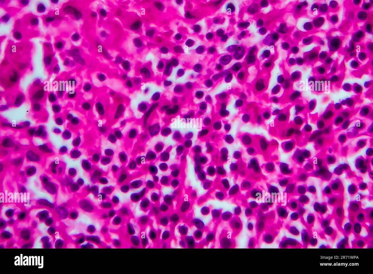 Non-Hodgkin's lymphoma, light micrograph, photo under microscope. High ...