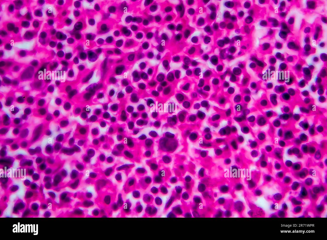 Non-Hodgkin's lymphoma, light micrograph, photo under microscope. High ...