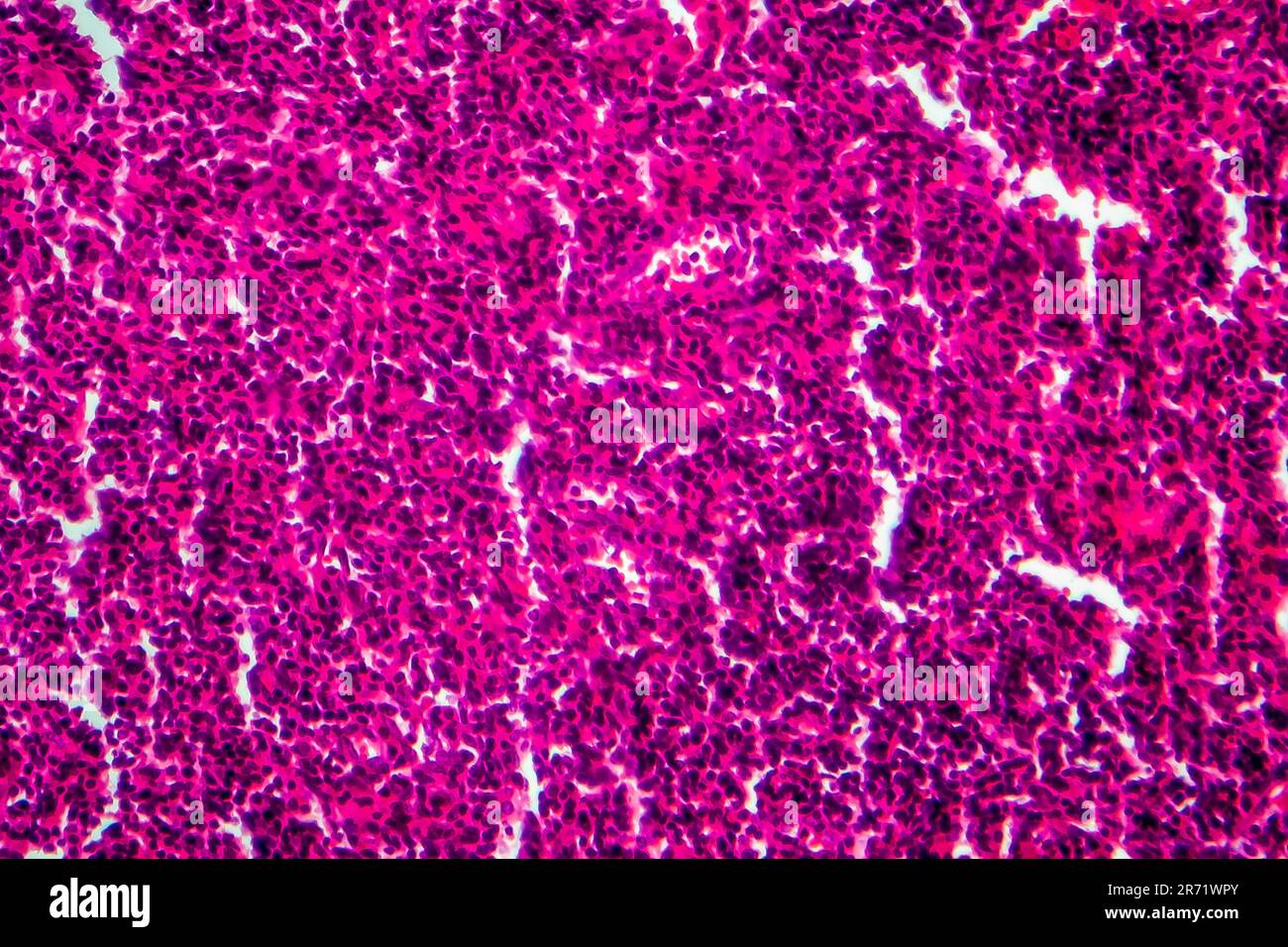 Non-Hodgkin's lymphoma, light micrograph, photo under microscope Stock ...