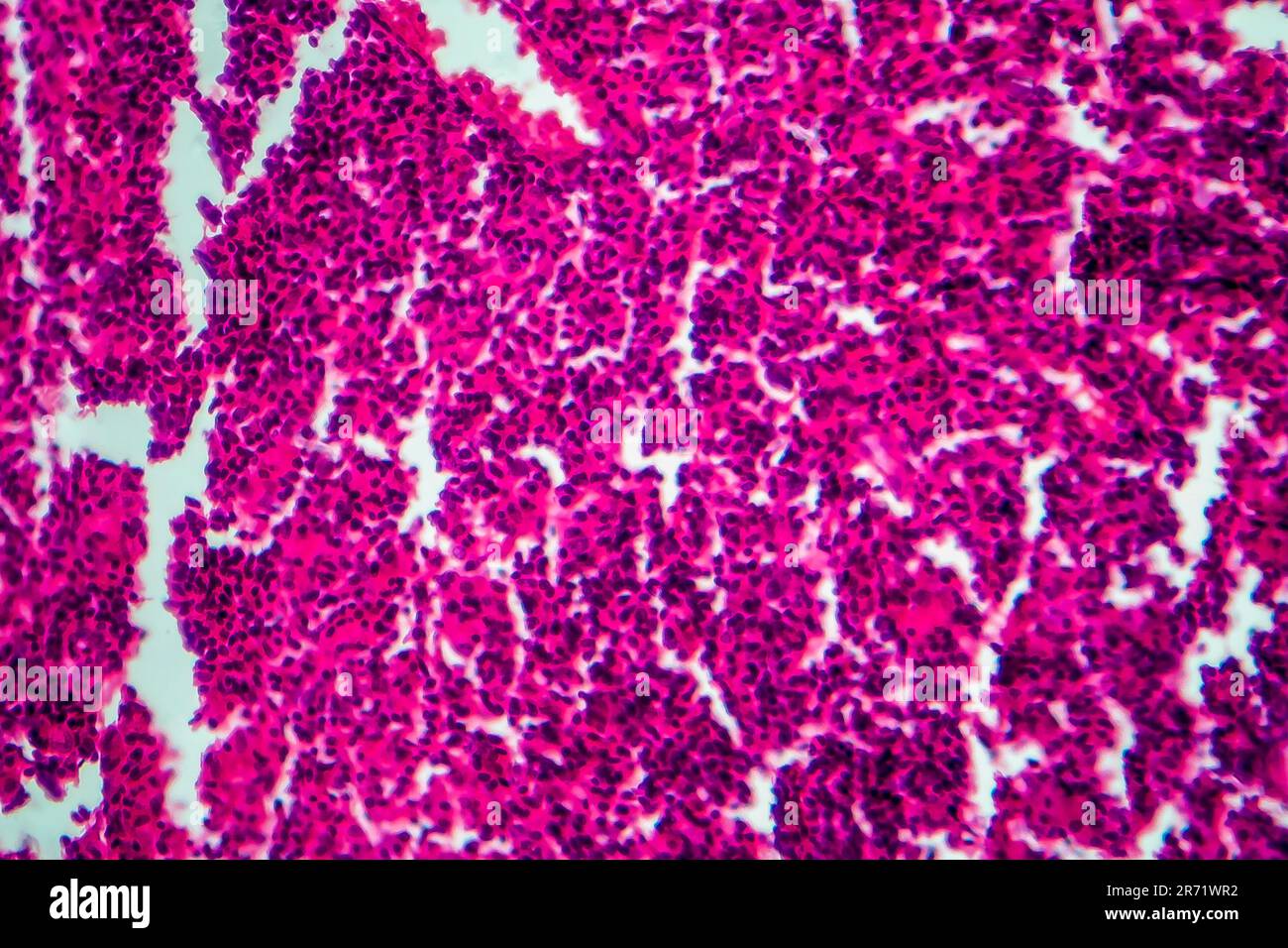 Non-Hodgkin's lymphoma, light micrograph, photo under microscope Stock ...