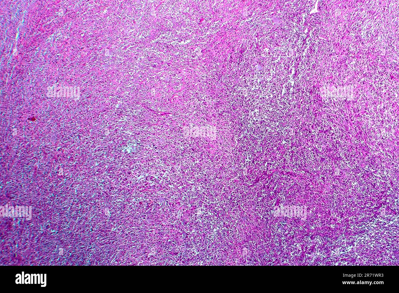 Hodgkin's lymphoma, light micrograph, photo under microscope Stock ...