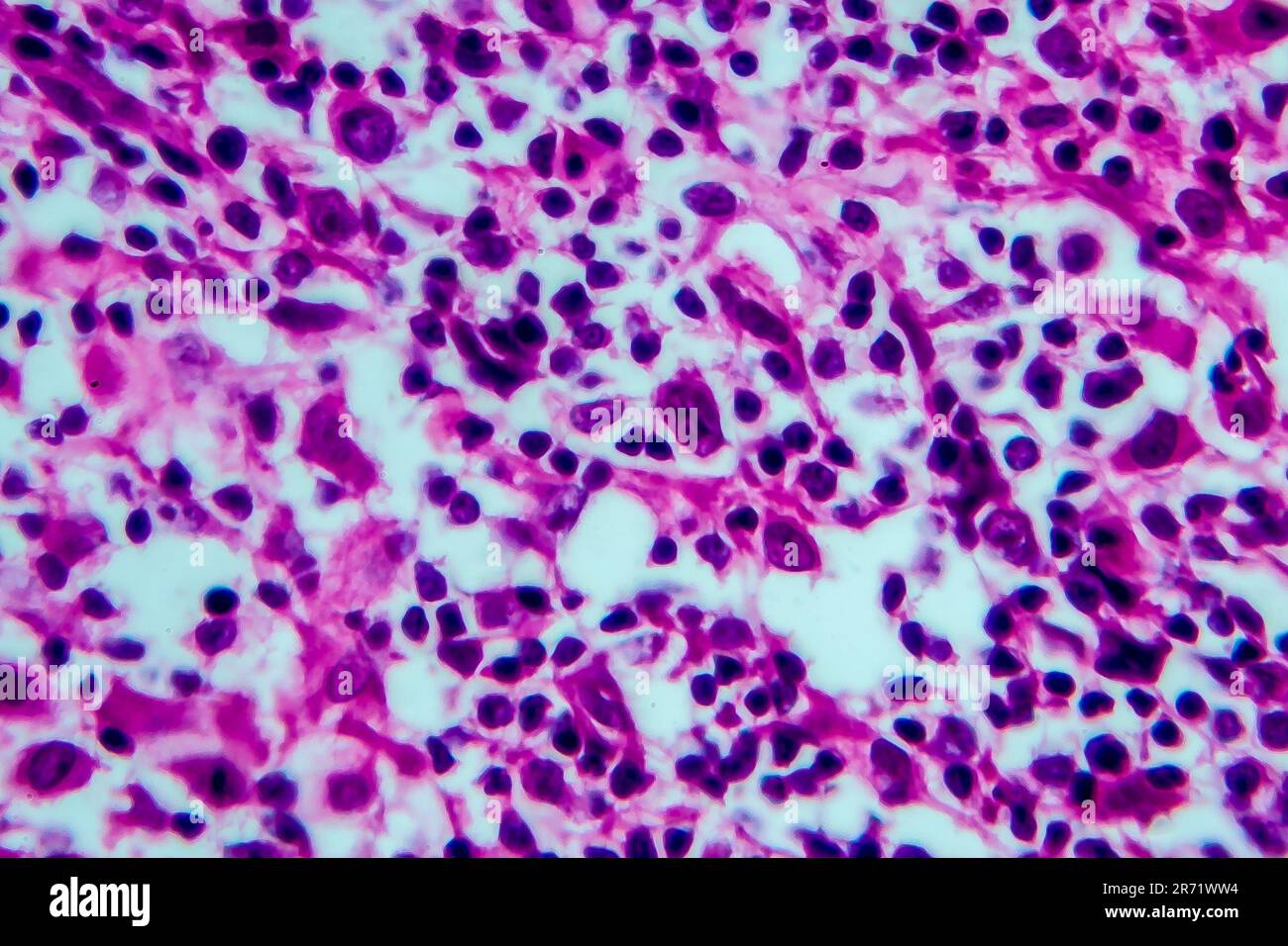 Hodgkin's lymphoma, light micrograph, photo under microscope. High ...