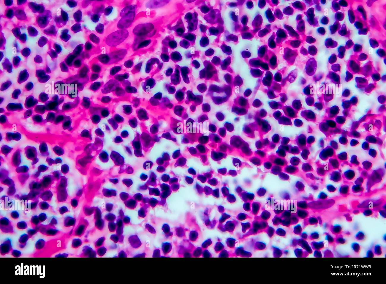 Hodgkin's lymphoma, light micrograph, photo under microscope. High ...