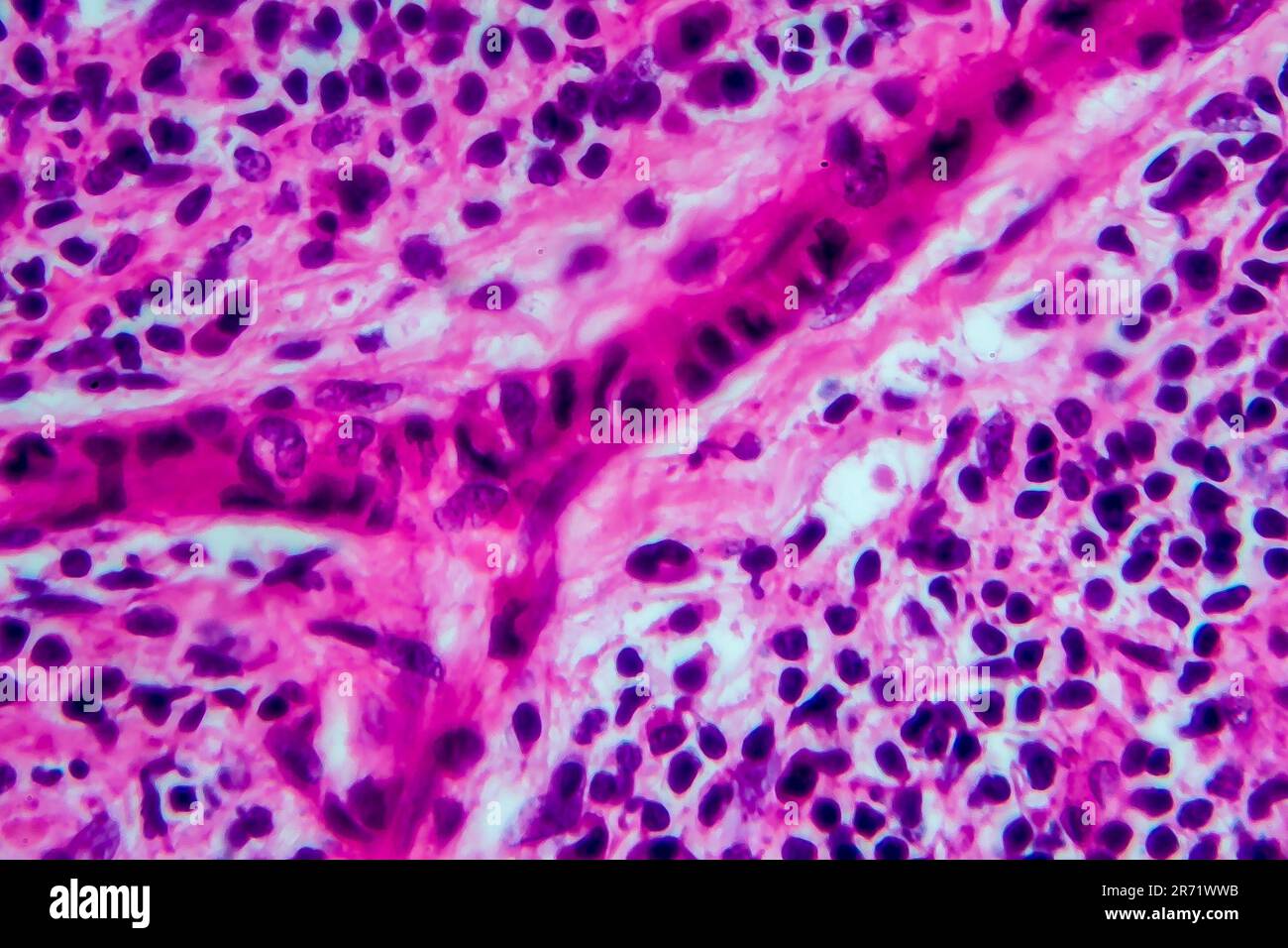 Hodgkin's lymphoma, light micrograph, photo under microscope. High ...